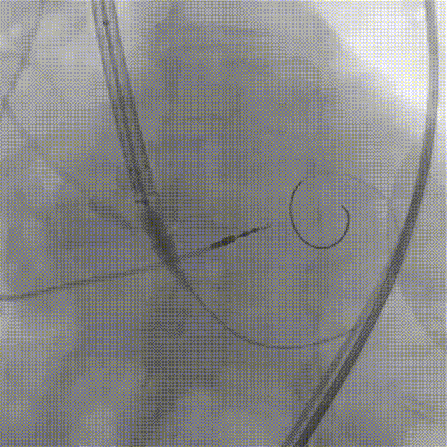 SCC 2023 | Live Case：广东省人民医院罗建方教授、李捷教授团队转播CTO-TAVR一站式手术-医谱