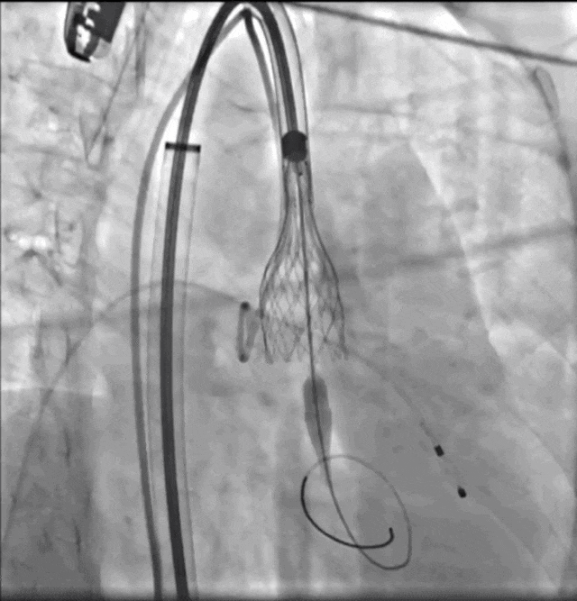 中国结构周2023| 研精致思、冷静突围——修建成教授团队完成冠脉阻塞高风险患者TAVR手术-医谱