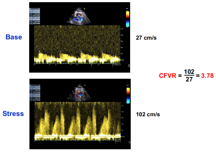 JAHA：TTE检测的高静息冠状动脉血流速度与CCS患者较差的生存率相关-医谱