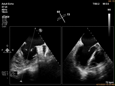 中山大学孙逸仙纪念医院陈样新教授团队完成MitraClip™治疗CRT术后重度二尖瓣关闭不全患者一例-医谱