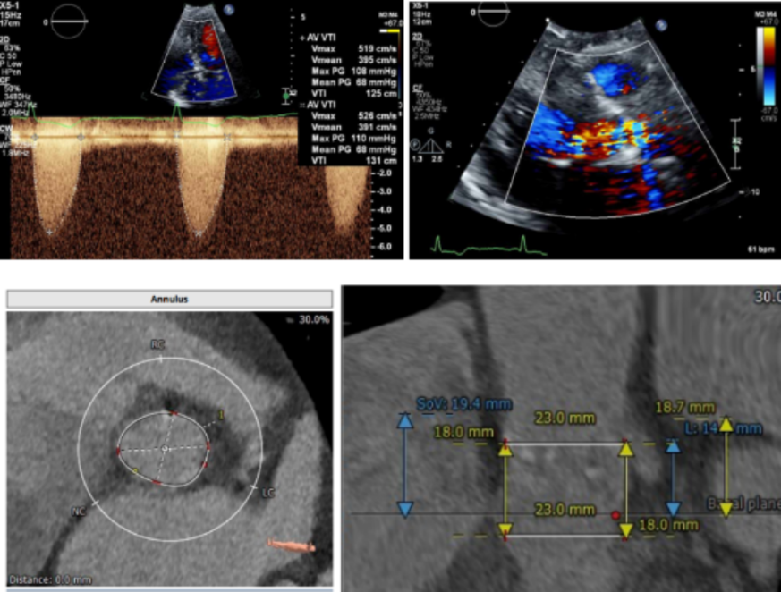 CCC Live Cases直播预告丨Sharma教授TF-TAVR手术娴熟演绎Evolut-FX瓣膜在瘦小患者中的应用-医谱